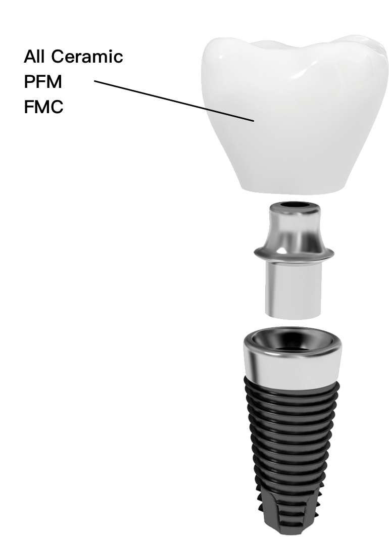 Implant Products - Bright Dental Lab