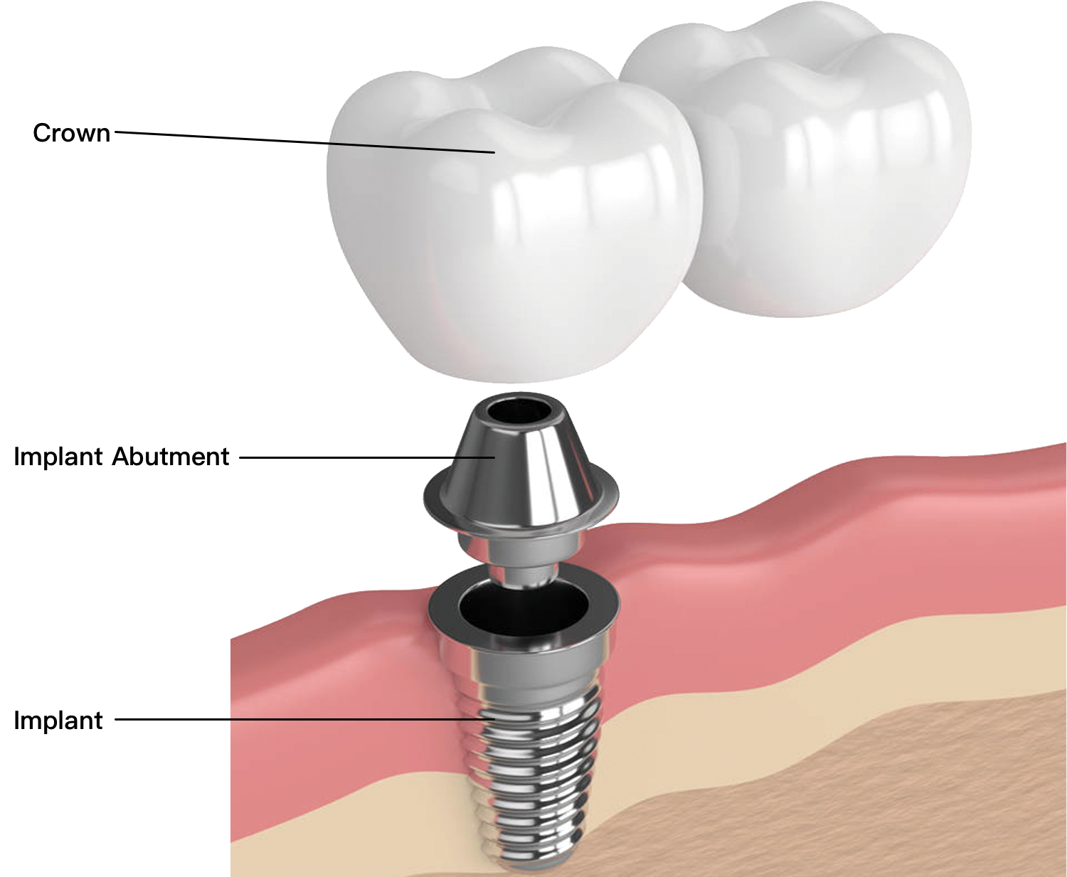 Implant Products - Bright Dental Lab