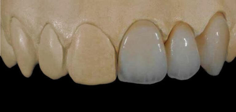 PFM/Snap-On Smile - Bright Dental Lab