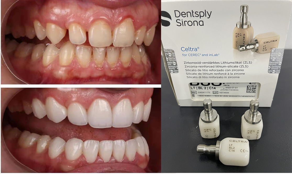 NEW CAD VENEERS - Bright Dental Lab