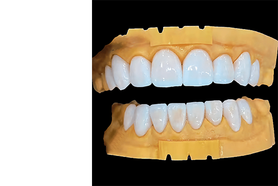 ALL-CERAMICS - Bright Dental Lab