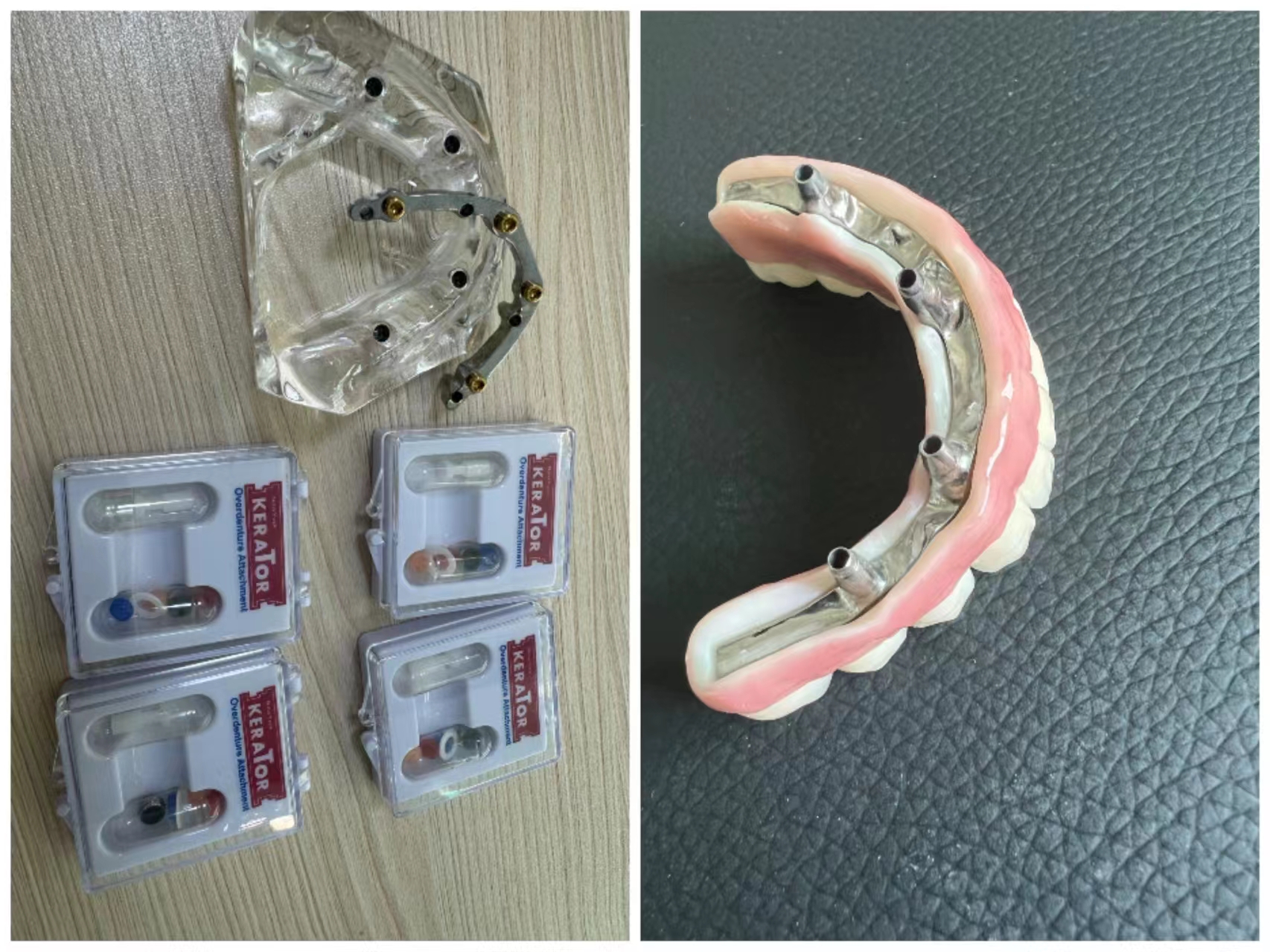 Implant Products - Bright Dental Lab