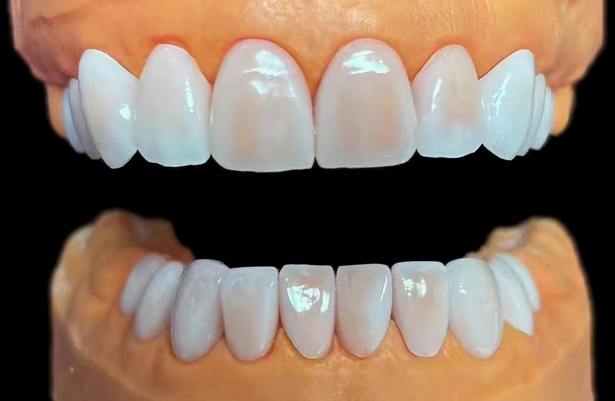 ALL-CERAMICS - Bright Dental Lab